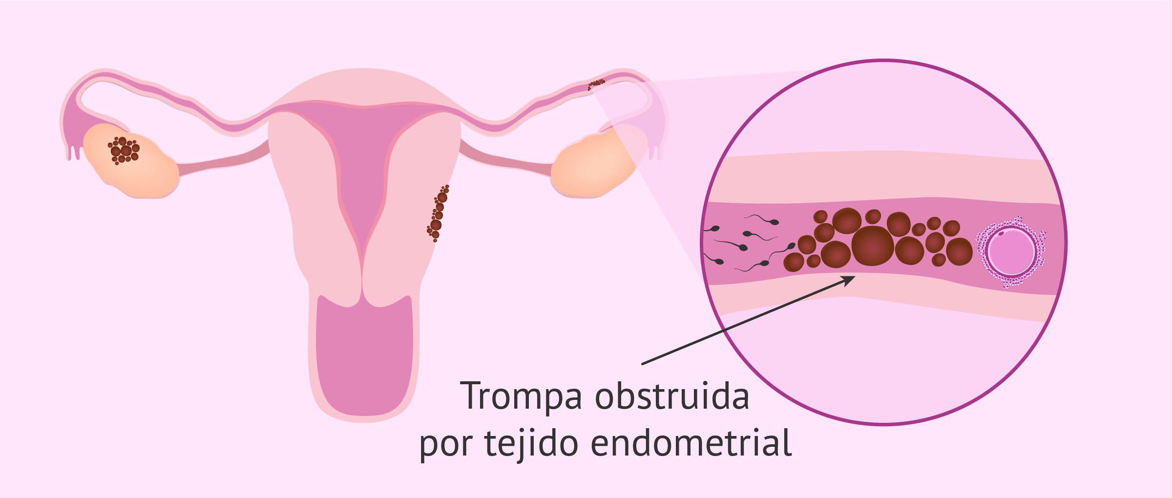 ¿Cómo afecta la endometriosis a la fertilidad de la mujer?