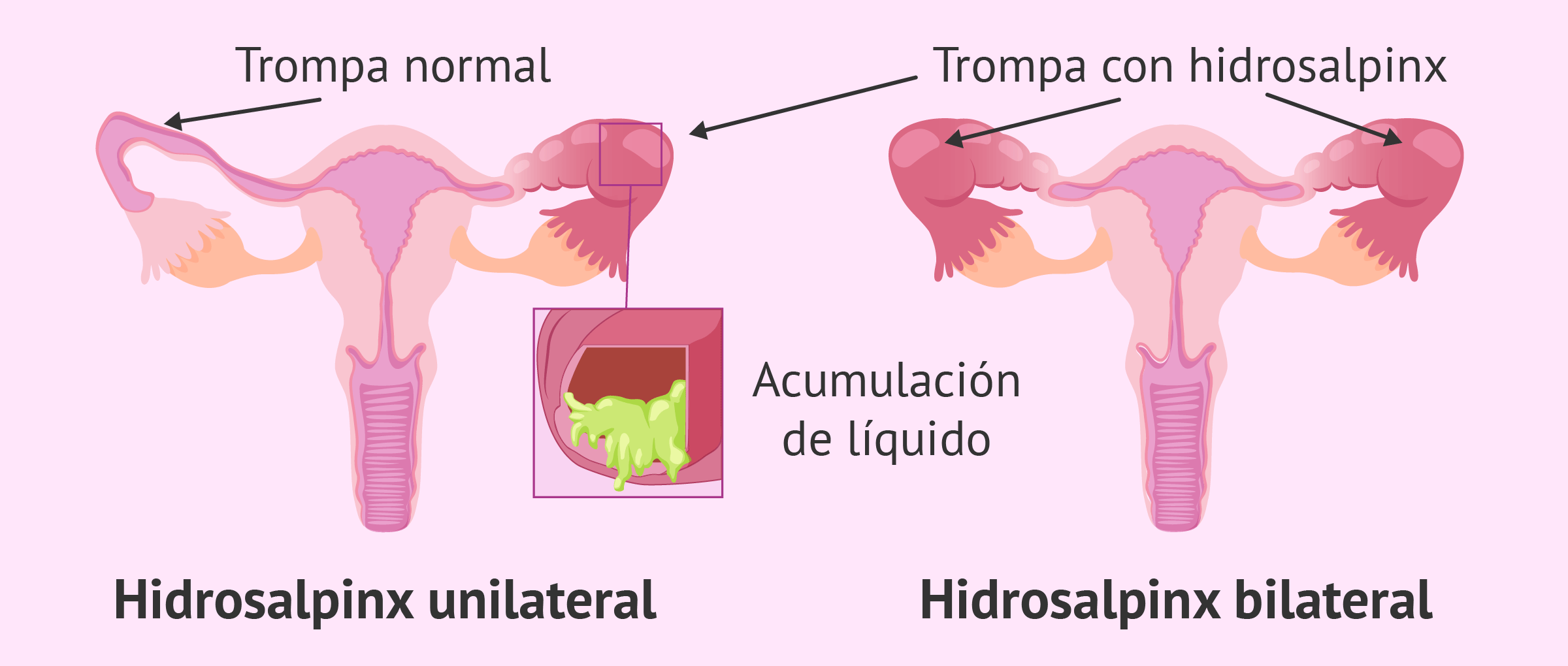 Obstrucción De Trompas De Falopio: Causas Y Tratamiento – GOMW