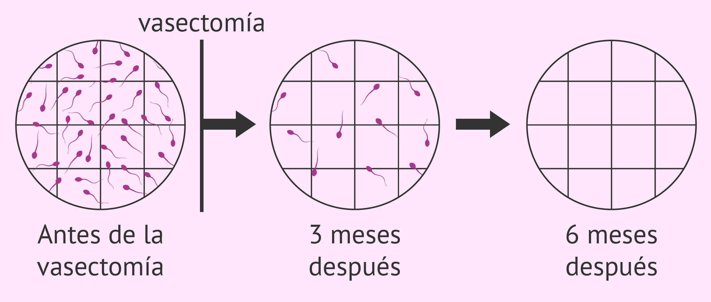 ¿Qué es el seminograma de control después de la vasectomía?