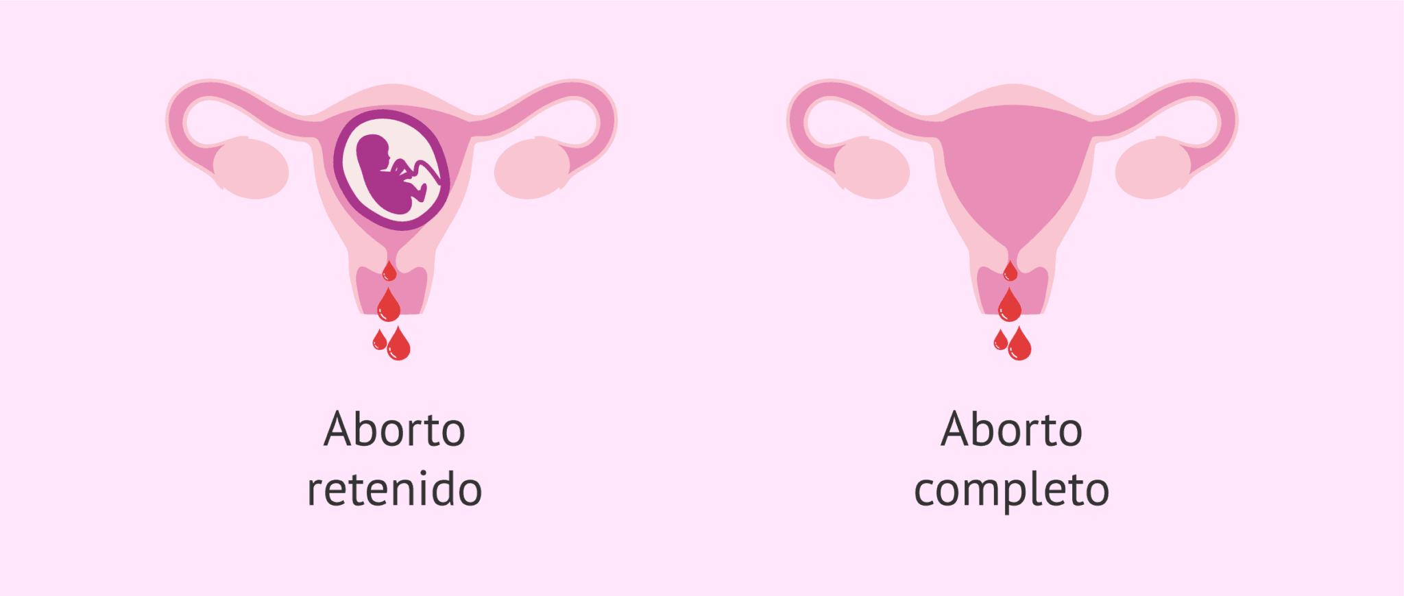 ¿Qué es un aborto diferido?