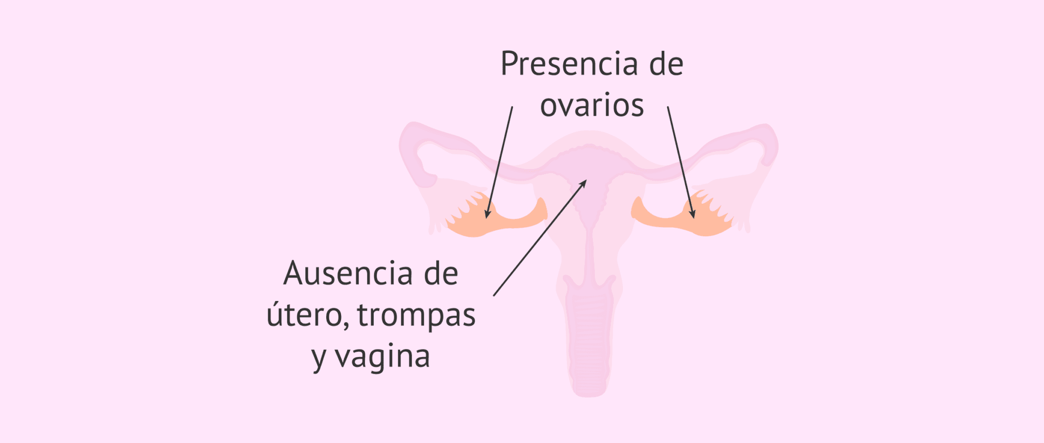 ¿Qué es la agenesia uterina?