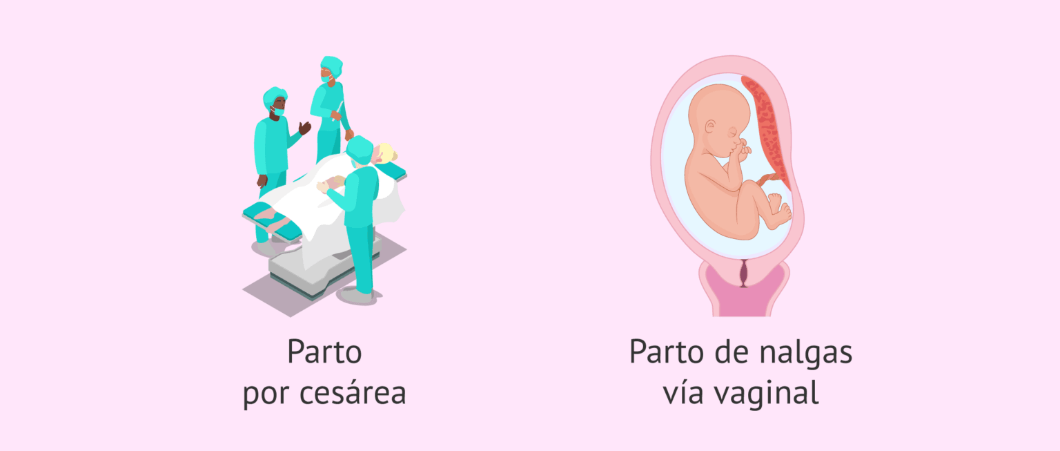 Bebé en posición podálica, ¿qué significa y qué hacer para cambiarla?