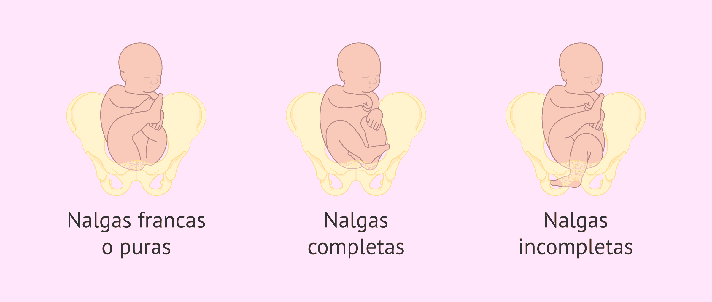 ¿Qué es la presentación podálica?