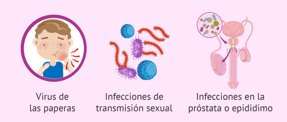 ¿Qué es la orquitis testicular? - Síntomas, causas y tratamiento