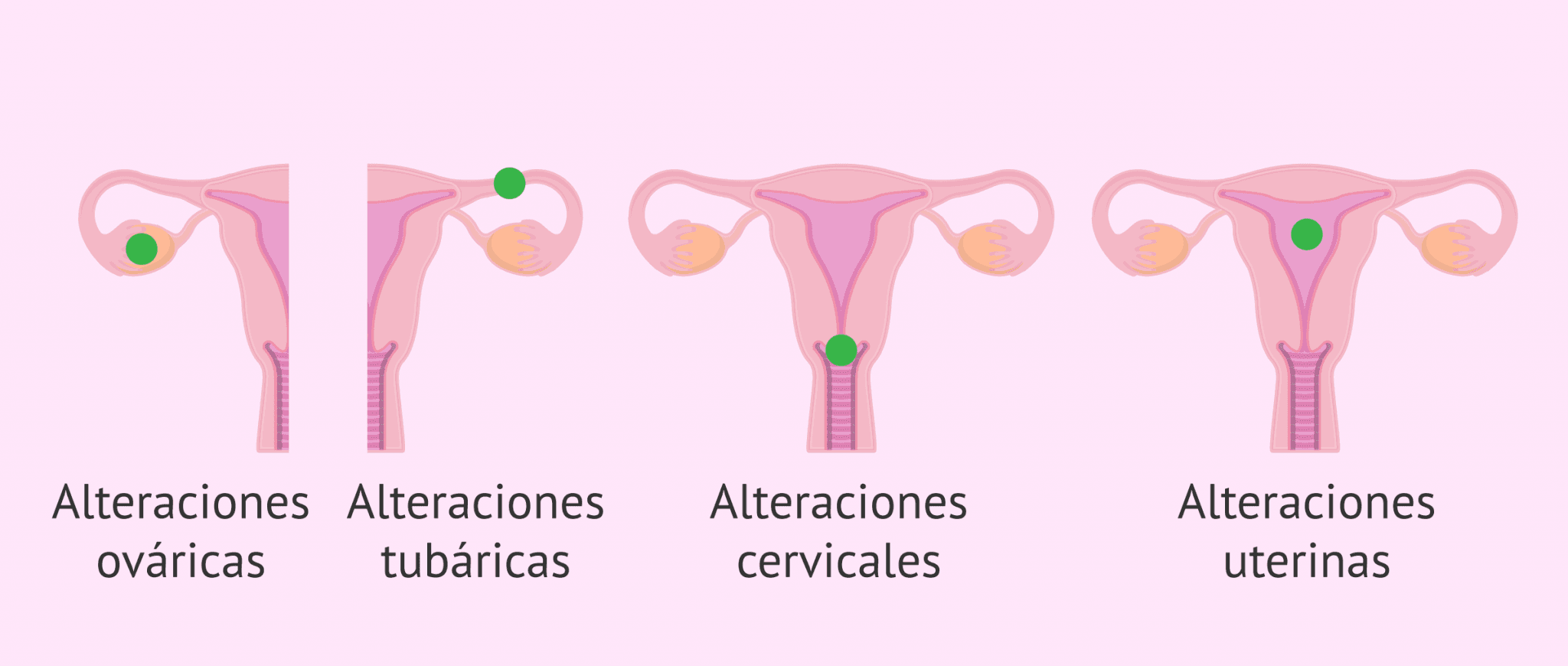 ¿Cuáles son las principales causas de esterilidad e infertilidad?