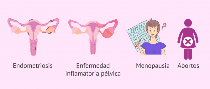 ¿Qué es el útero retroverso? - Causas y síntomas
