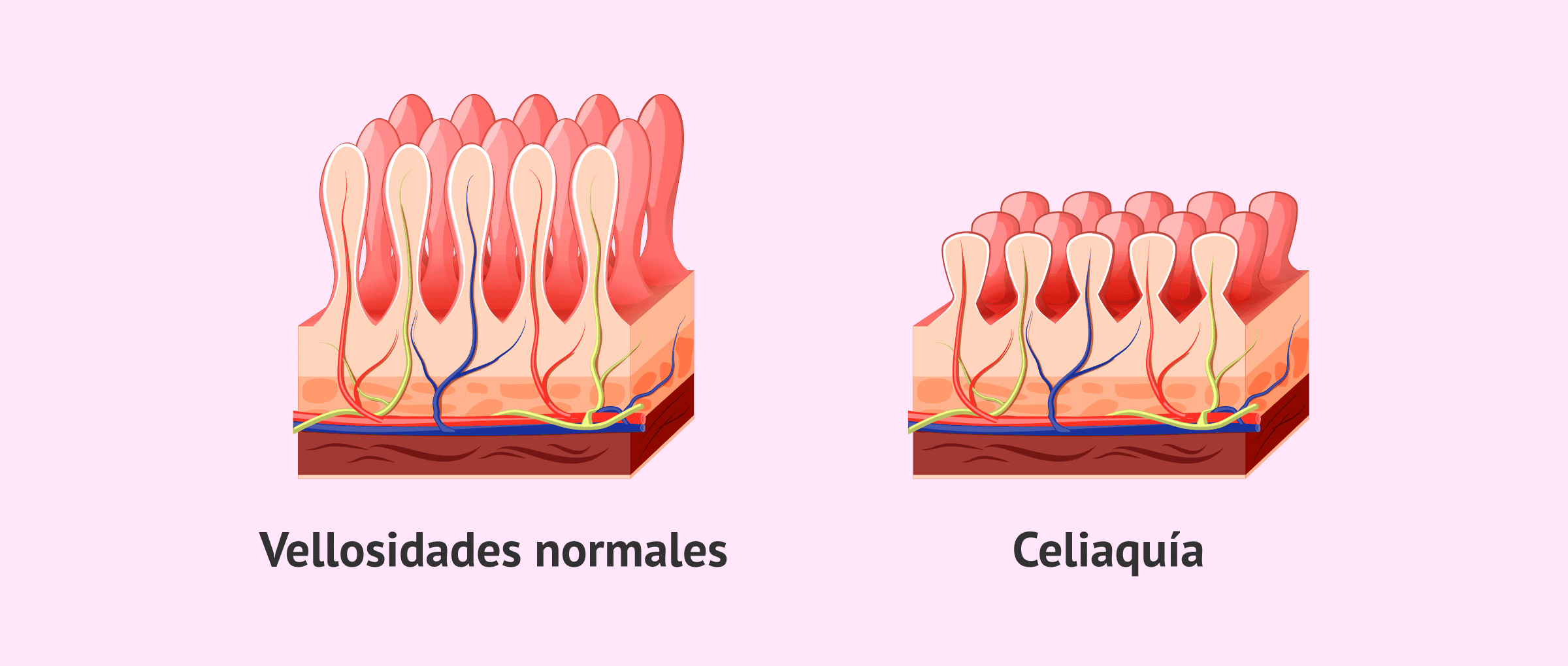 Vellosidades intestinales en pacientes con celiaquía