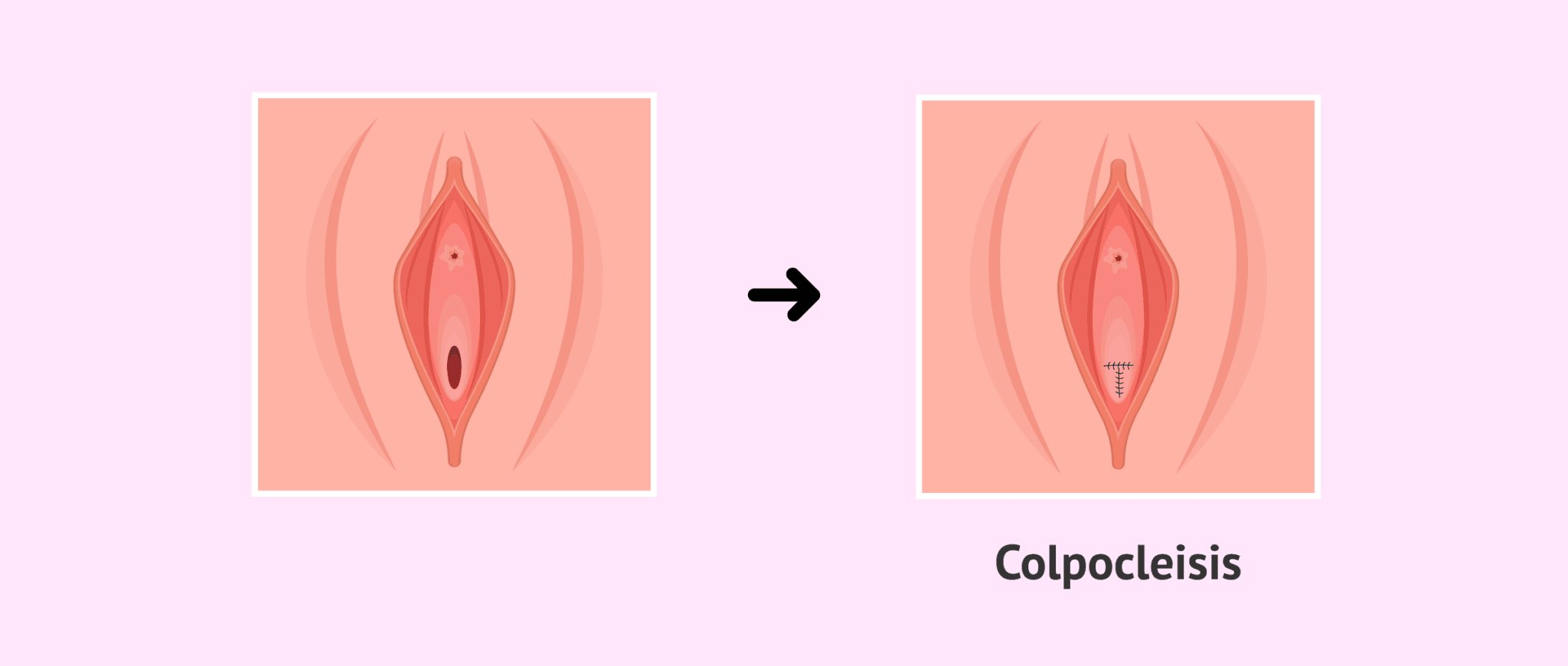 ¿Qué es la colpocleisis?