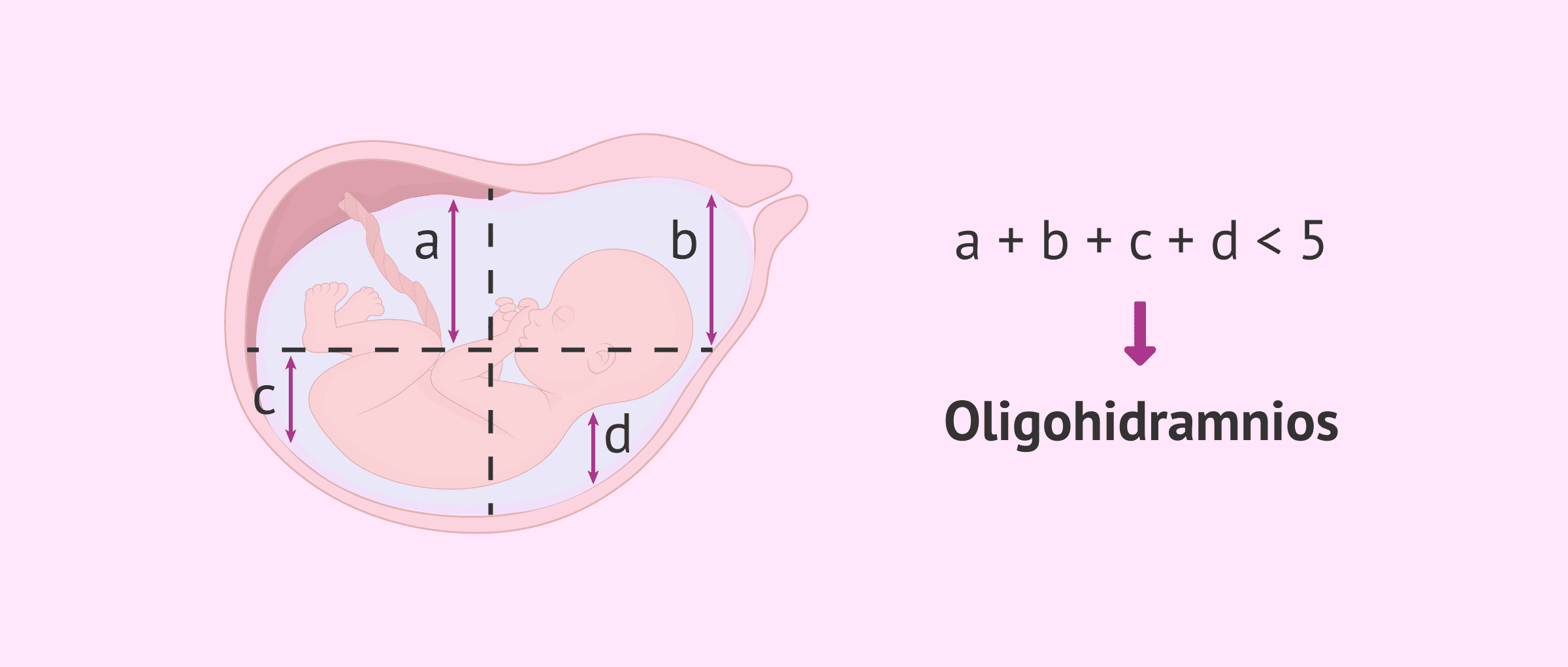 Oligohidramnios: Causas, Diagnóstico Y Tratamiento En El Embarazo – XNCUC