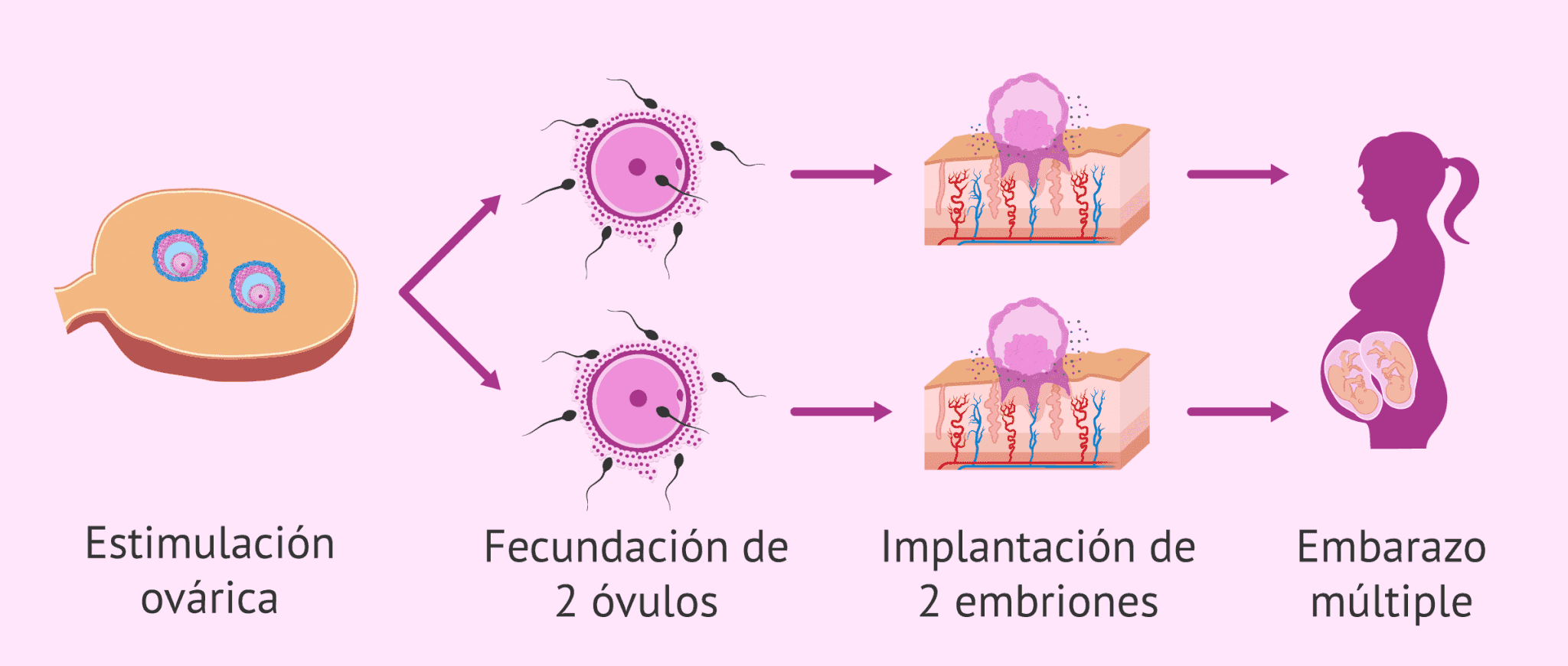 Los embarazos múltiples en reproducción asistida: ventajas y desventajas