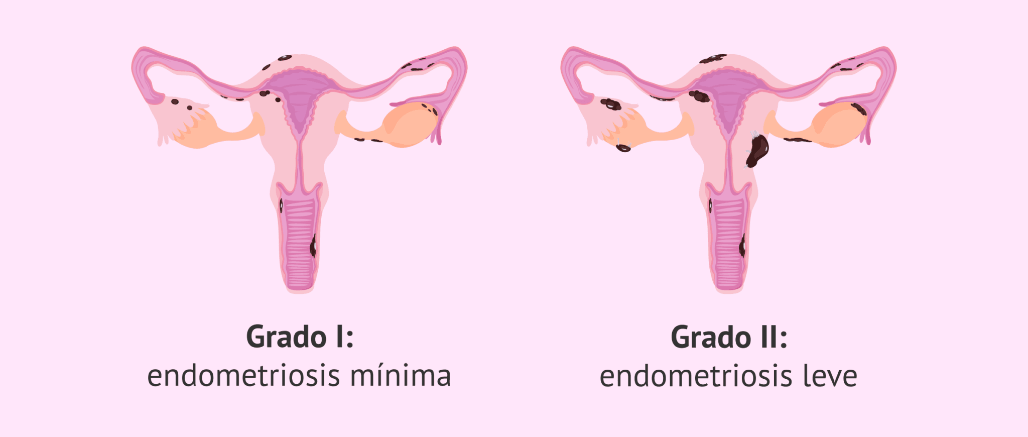 Endometriosis: localización, síntomas, diagnóstico y tratamiento