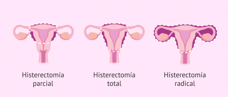 ¿qué Es La Histerectomía