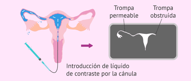 Obstrucción de trompas de Falopio: causas, diagnóstico y tratamiento