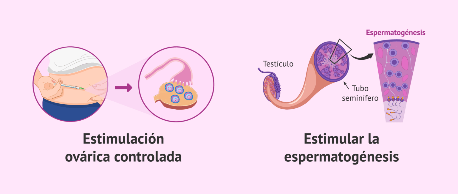 Gonal-f 75: solución inyectable con bajas dosis de la hormona FSH