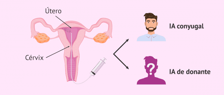 ¿Cuáles son las ventajas y desventajas de la inseminación artificial?