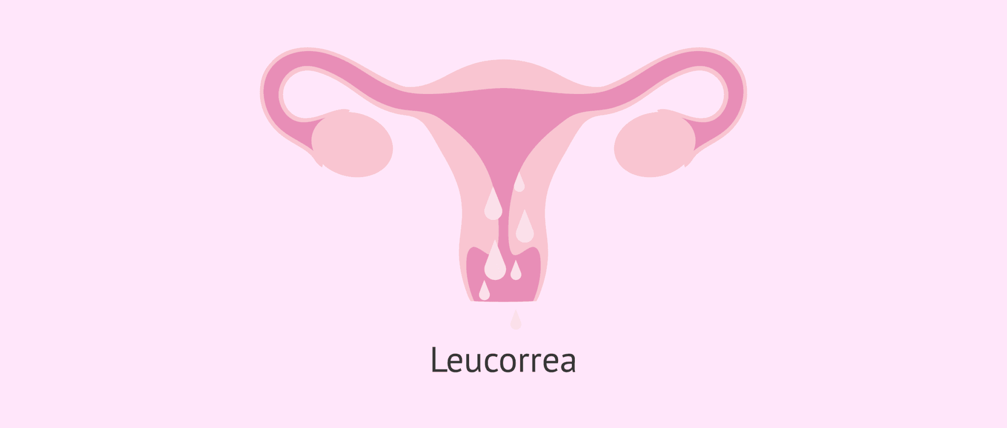 ¿Qué es la leucorrea?