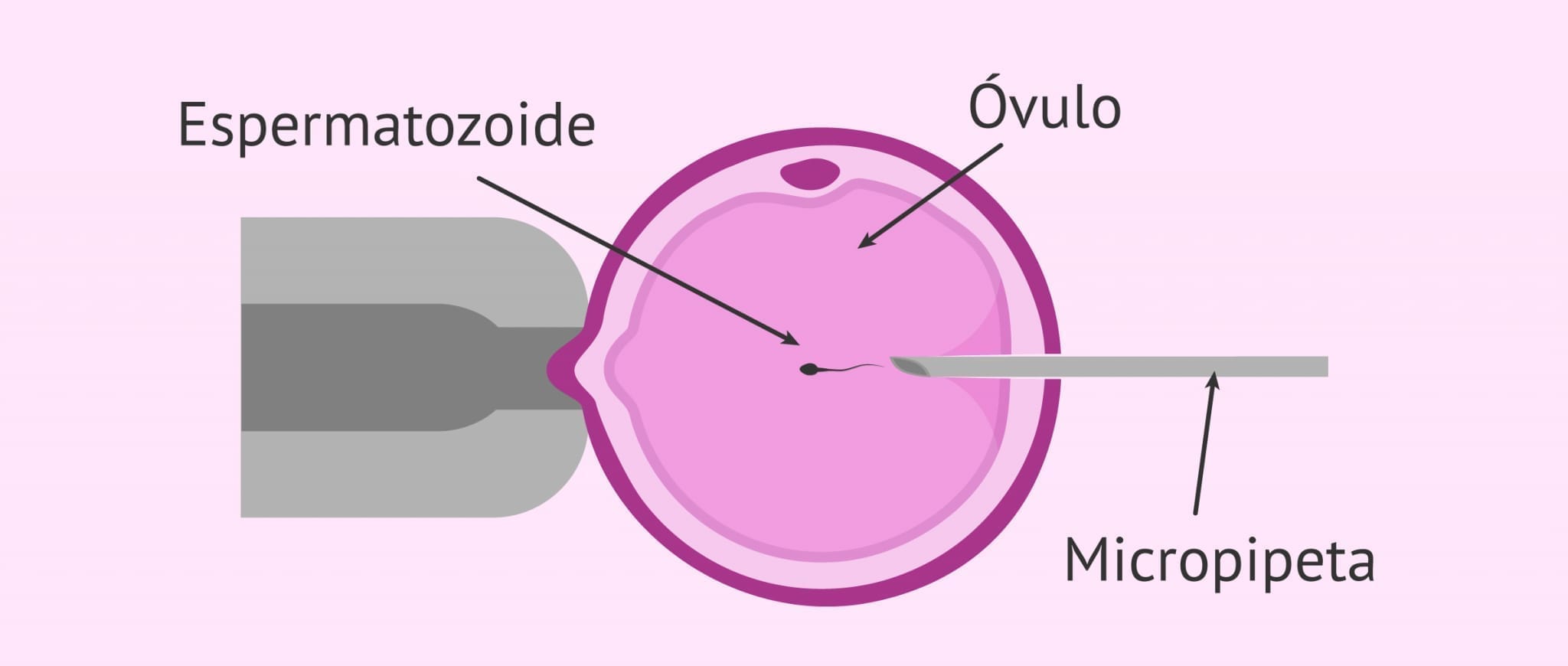 ¿Cómo es el proceso de ICSI paso a paso? - Fases del tratamiento