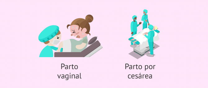 Parto vaginal versus cesárea