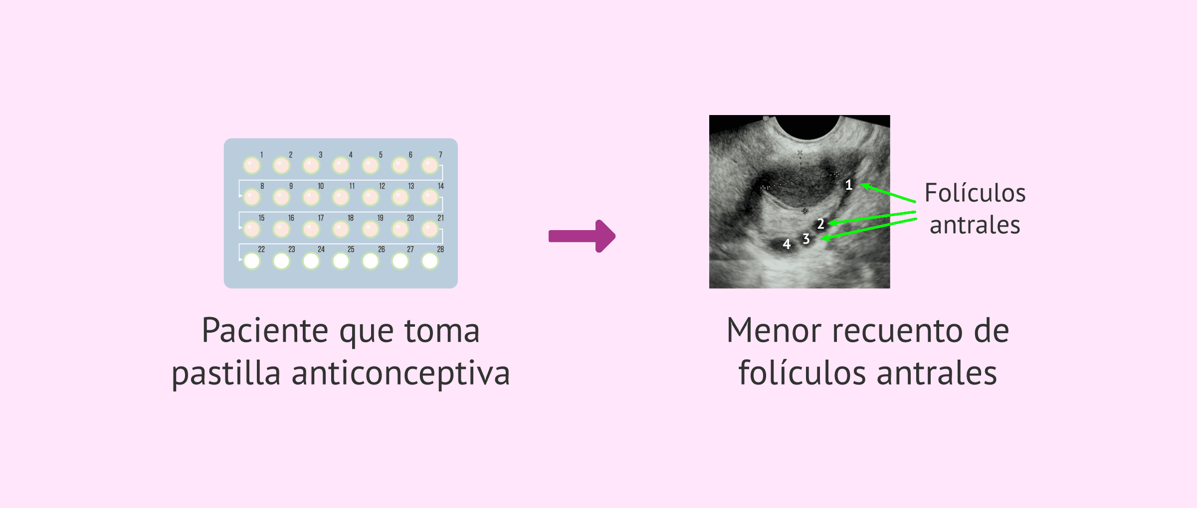¿Las pastillas anticonceptivas reducen el número de folículos antrales?
