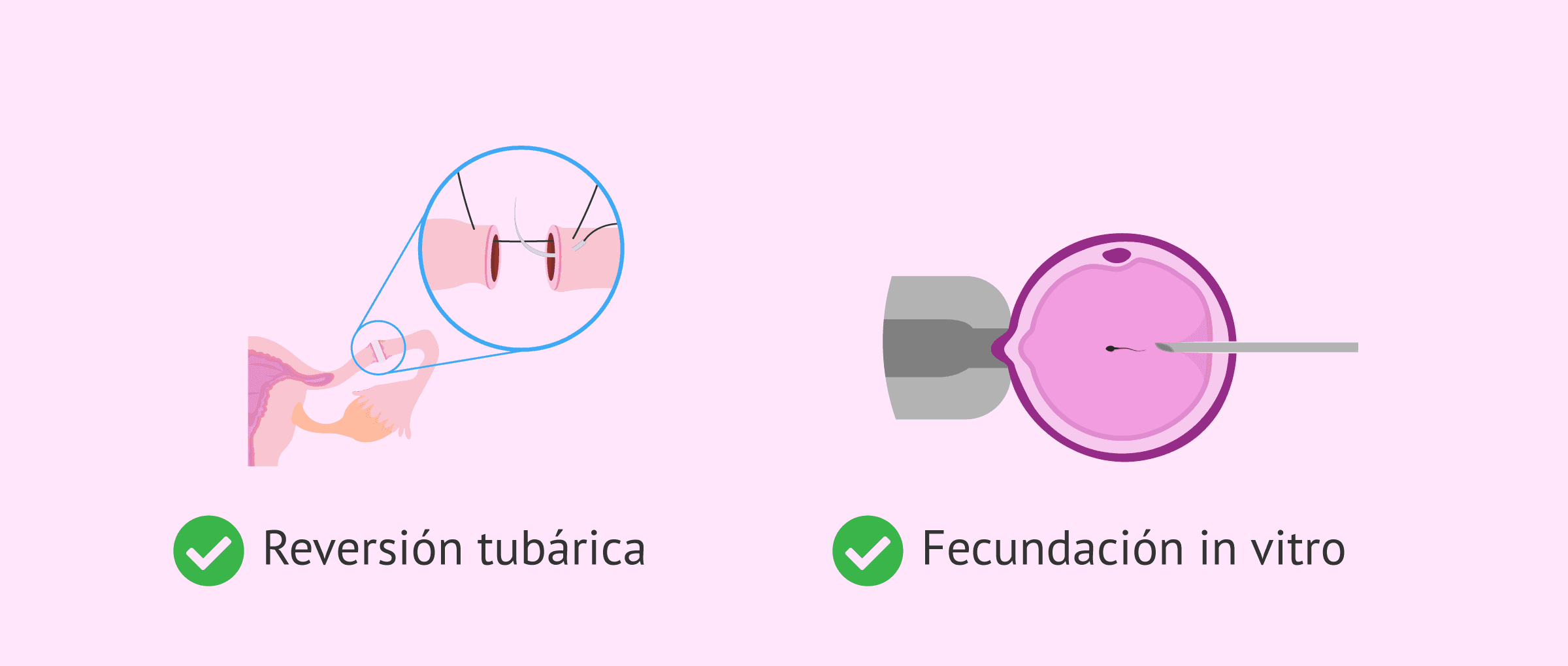 Posibilidad de embarazo con una ligadura de trompas de Falopio