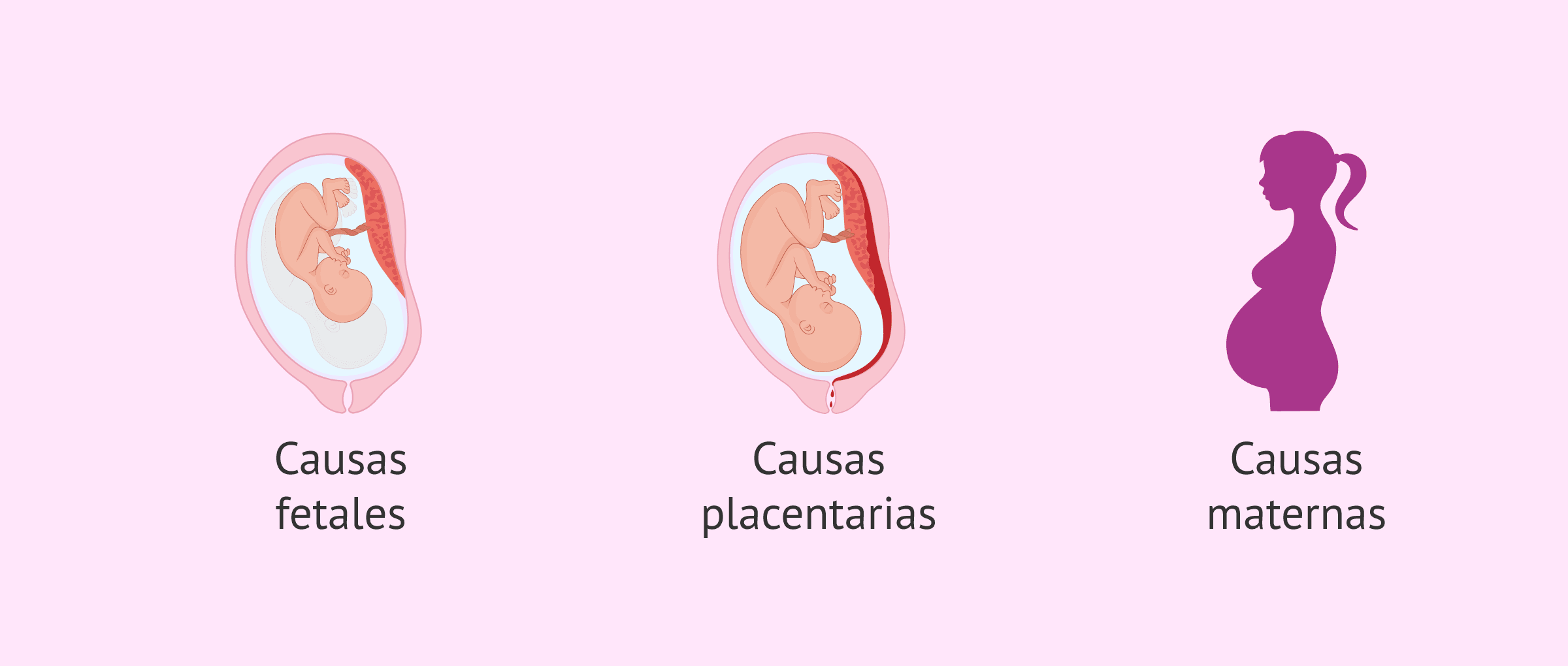 Oligohidramnios: causas, diagnóstico y tratamiento en el embarazo
