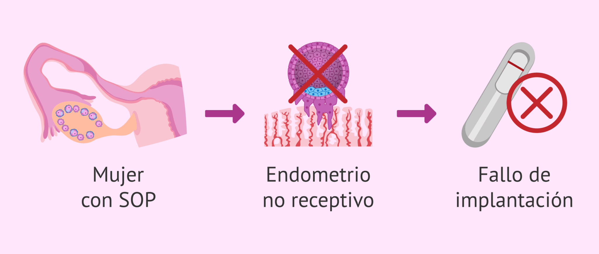 Fertilidad con el síndrome de ovarios poliquísticos (SOP)