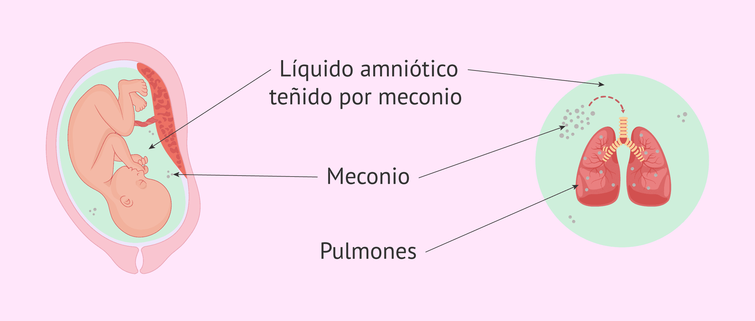¿Qué es y cuándo se produce el síndrome de aspiración de meconio?