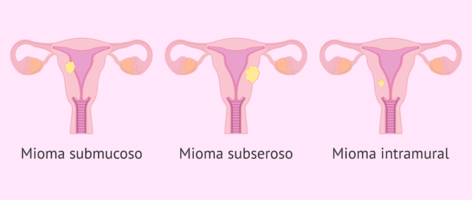 ¿Un mioma de 5 cm se opera antes de una FIV?