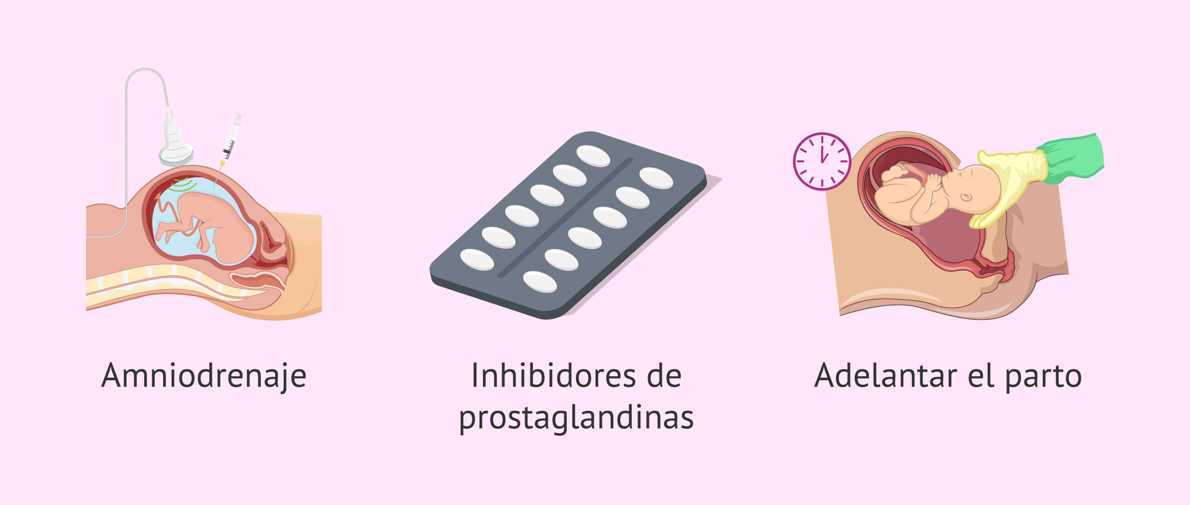 Opciones de tratamientos para el polihidramnios