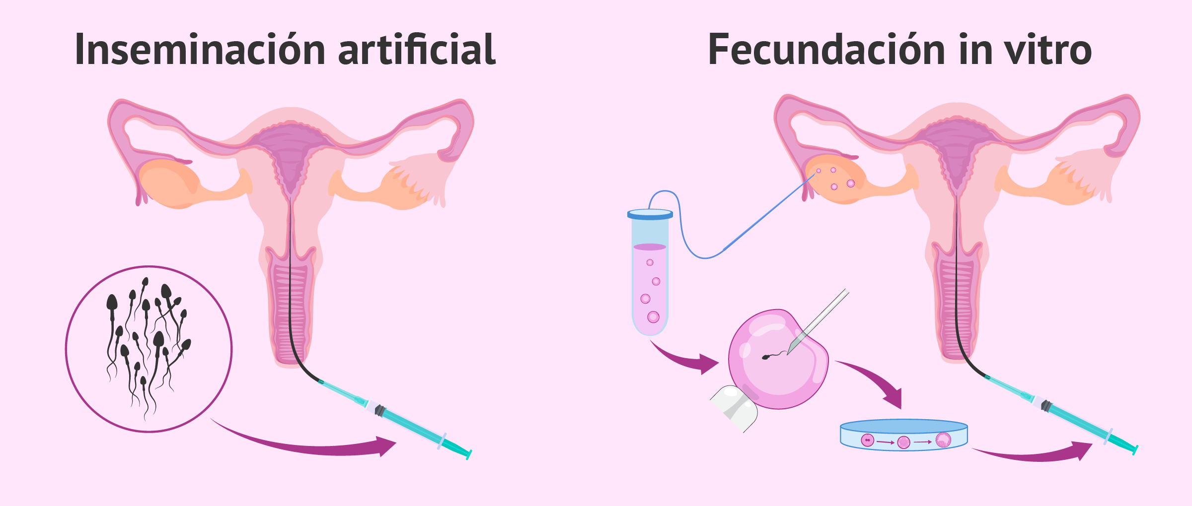 Diferencias entre inseminación artificial y fecundación in vitro