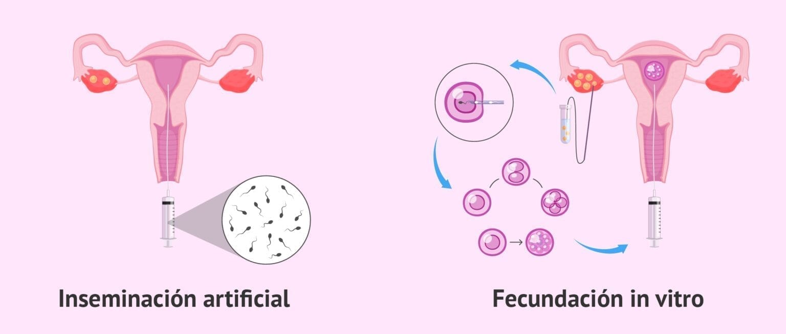 La inseminación artificial (IA): ¿Qué es y cuál es su precio?