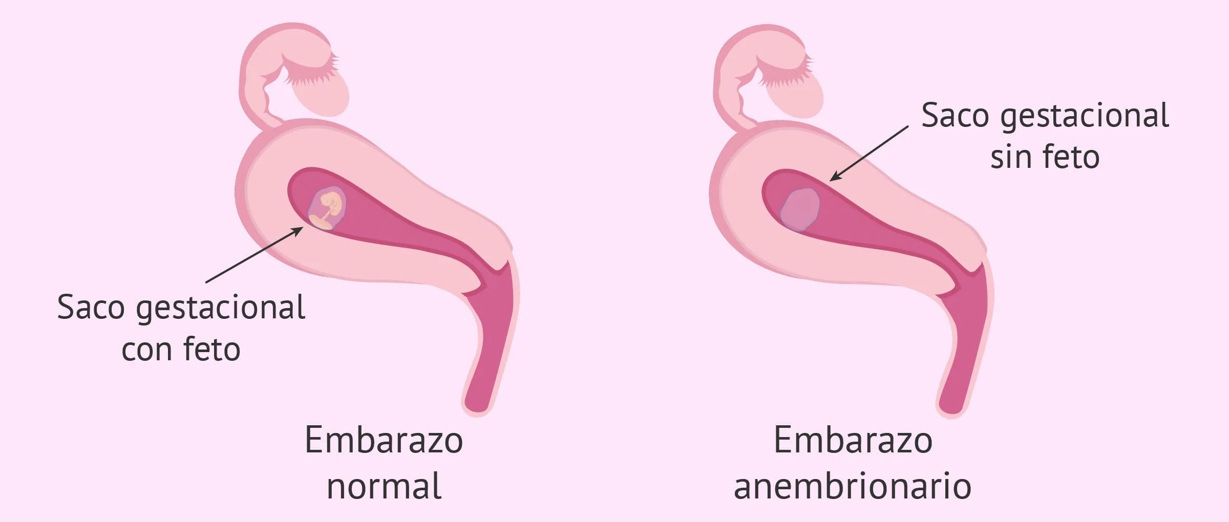 Diagnóstico del embarazo anembriónico: saco gestacional sin feto