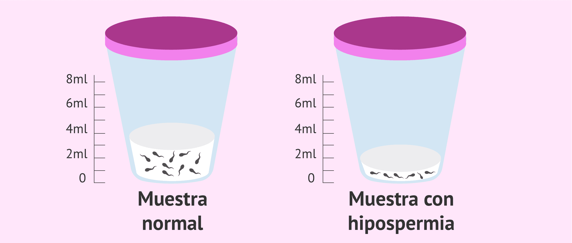 Semen eyaculado con hipospermia