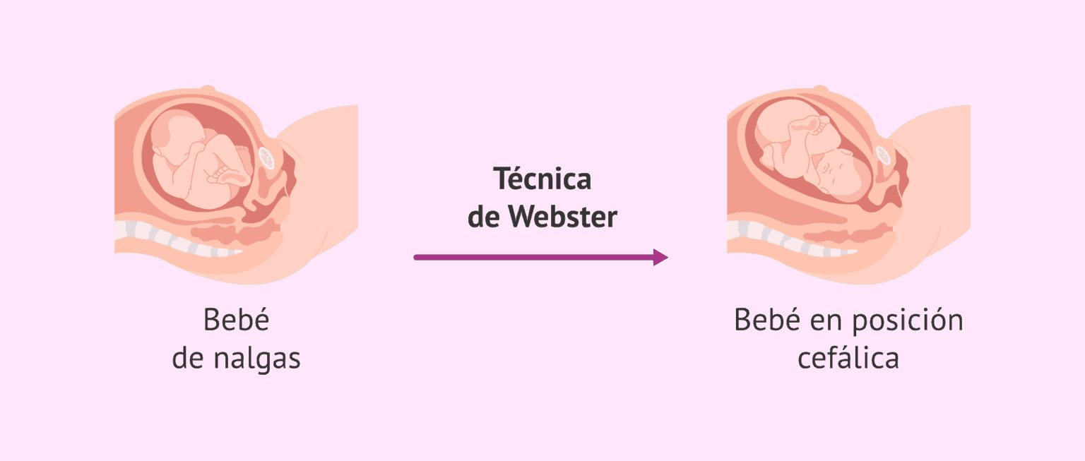 Cambiar la posición del feto con la técnica de Webster