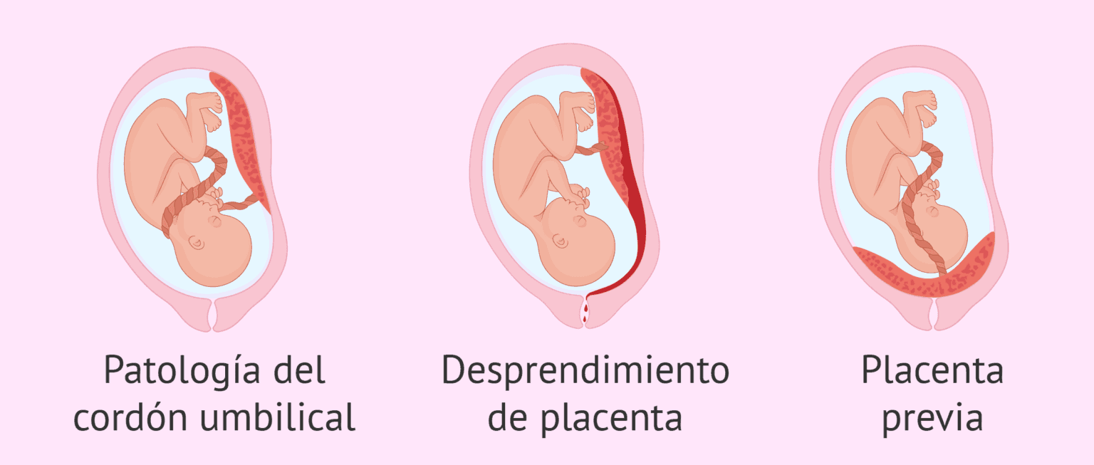 Muerte fetal intrauterina: síntomas, causas y apoyo emocional