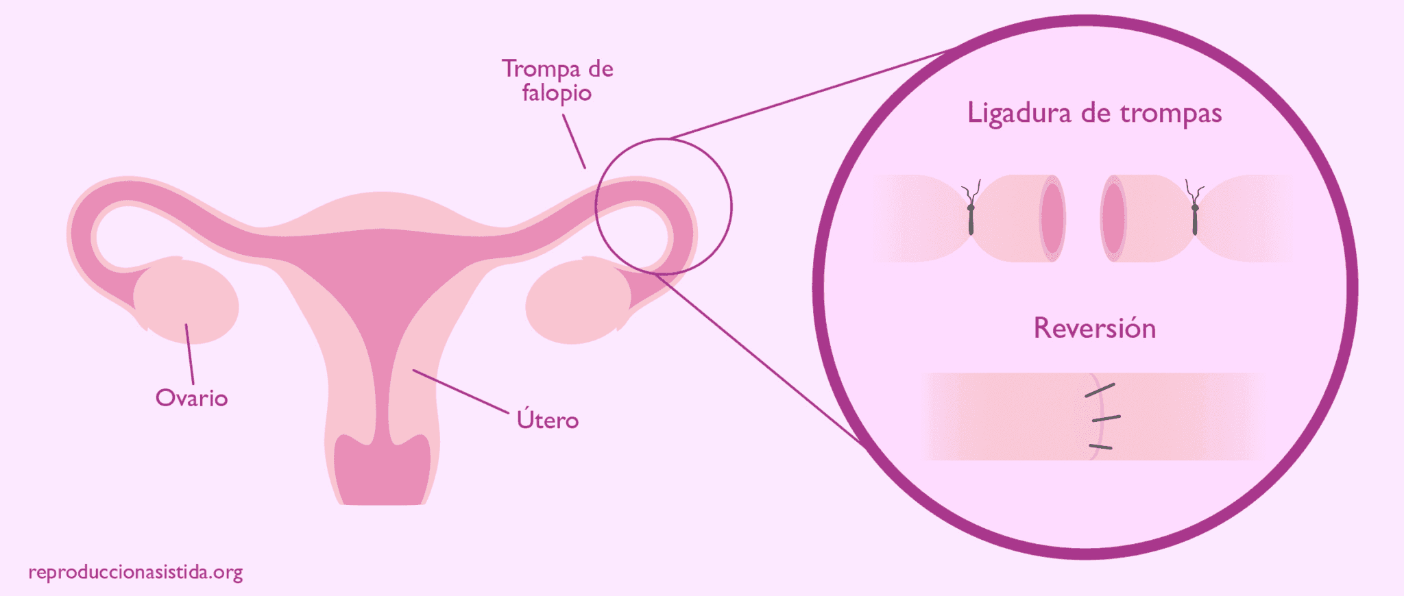 deshacer-la-ligadura-de-trompas-de-falopio