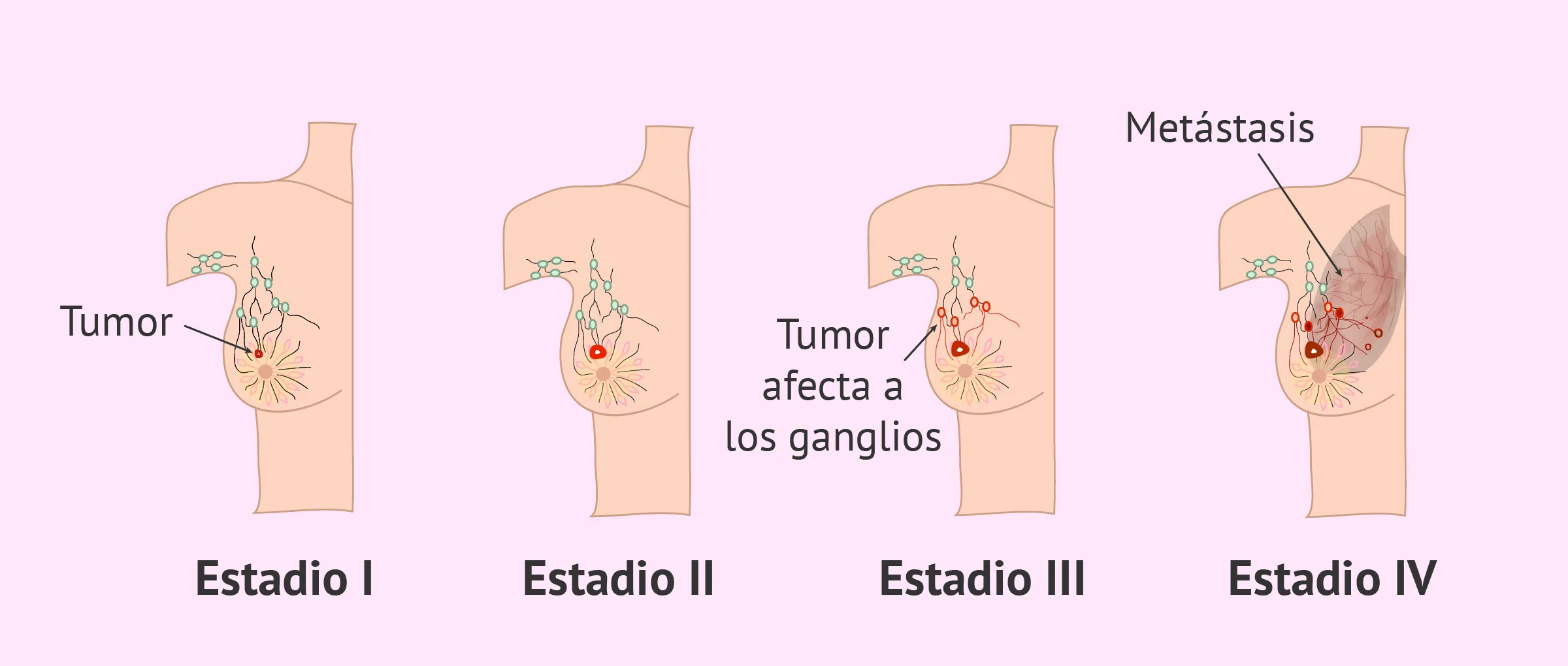 Sintomas De Cancer De Seno En Espanol Cáncer De Mama: Tratamientos,