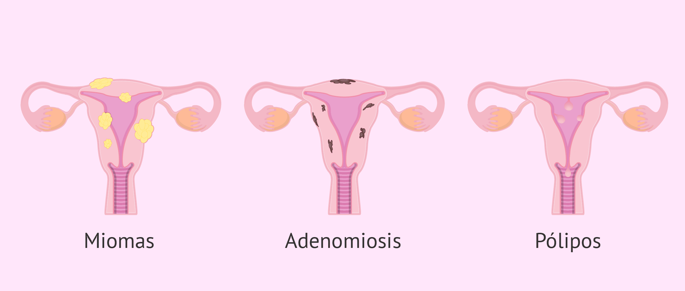Tumoraciones en el útero: miomas, adenomiosis y pólipos