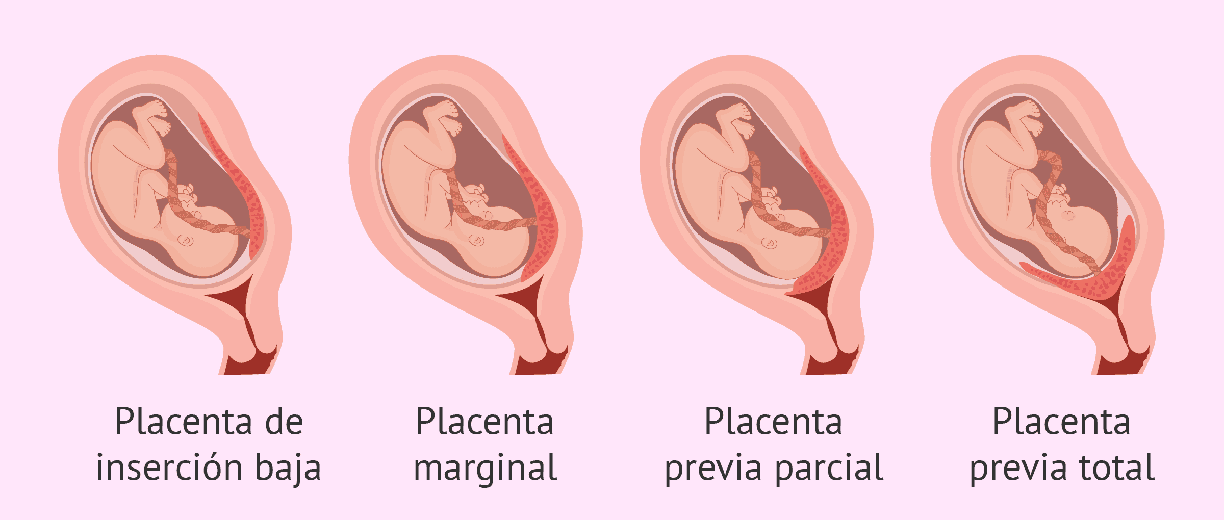 Clasificación De Placenta Previa