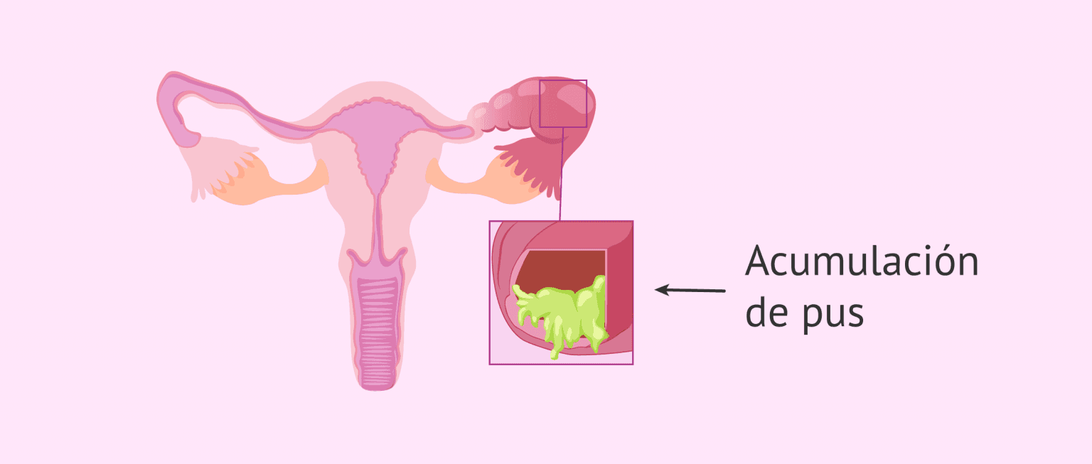 ¿Qué es el piosálpinx?