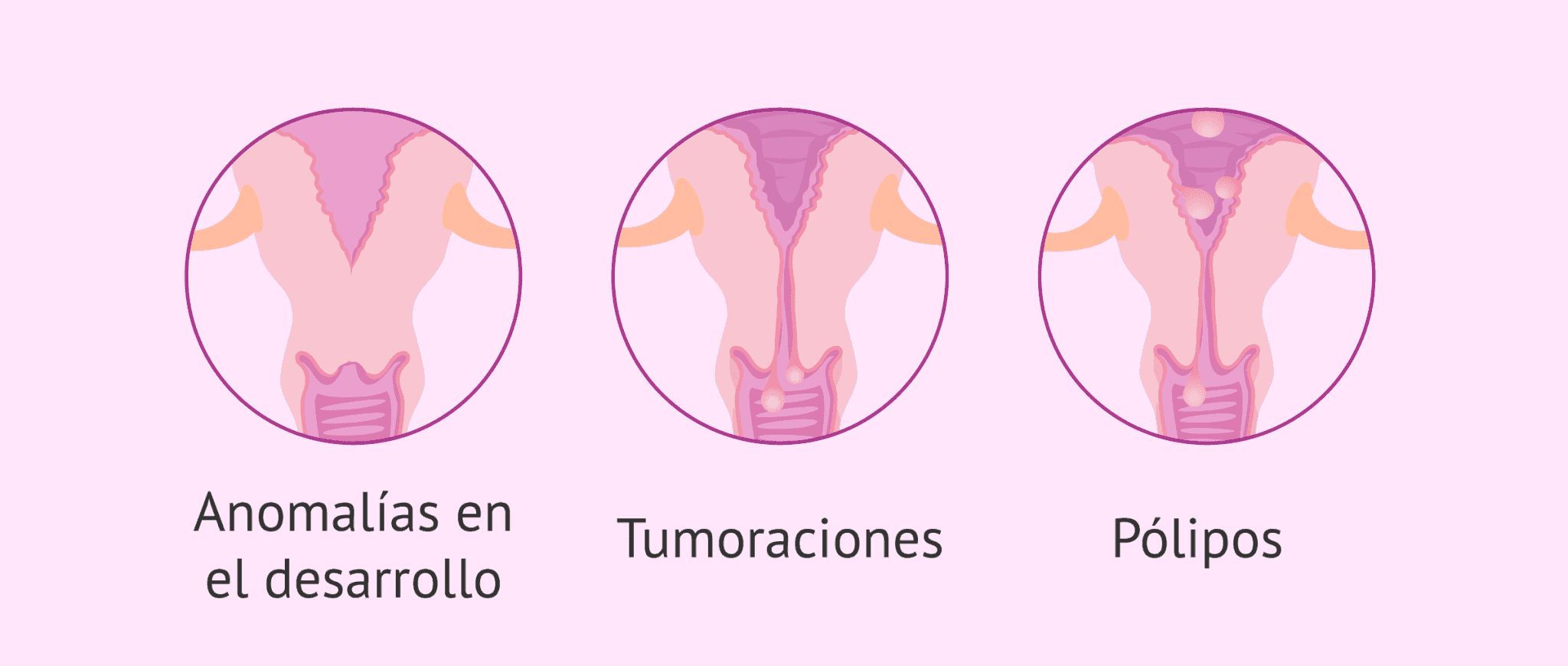 Causas de esterilidad por factor cervical