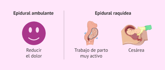 Anestesia Epidural En El Parto: Todo Lo Que Tienes Que Saber – YWTP