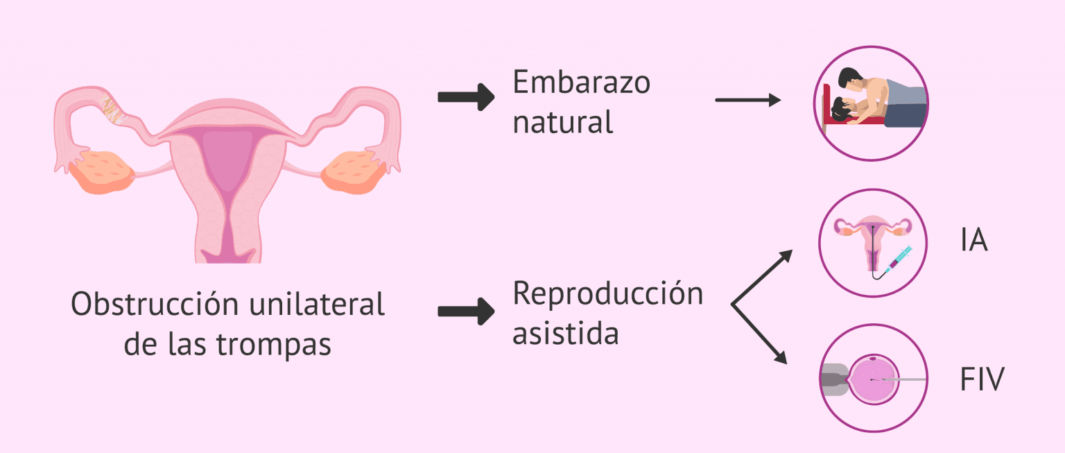 La cirugía como solución a los problemas en las trompas de Falopio