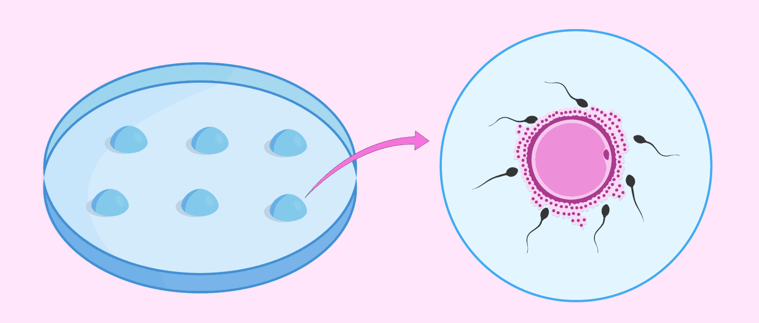 FIV o ICSI: ¿Cuál es la diferencia? ¿Qué es mejor?