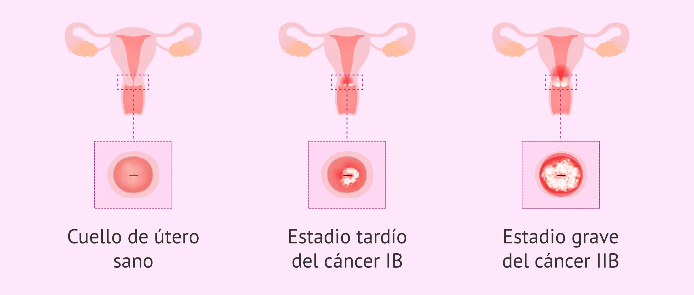 Cancer De Cuello Uterino Sintomas Cancer De Cuello Uterino Sintomas
