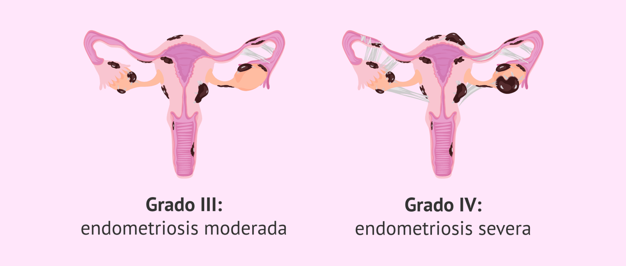 Endometriosis: localización, síntomas, diagnóstico y tratamiento