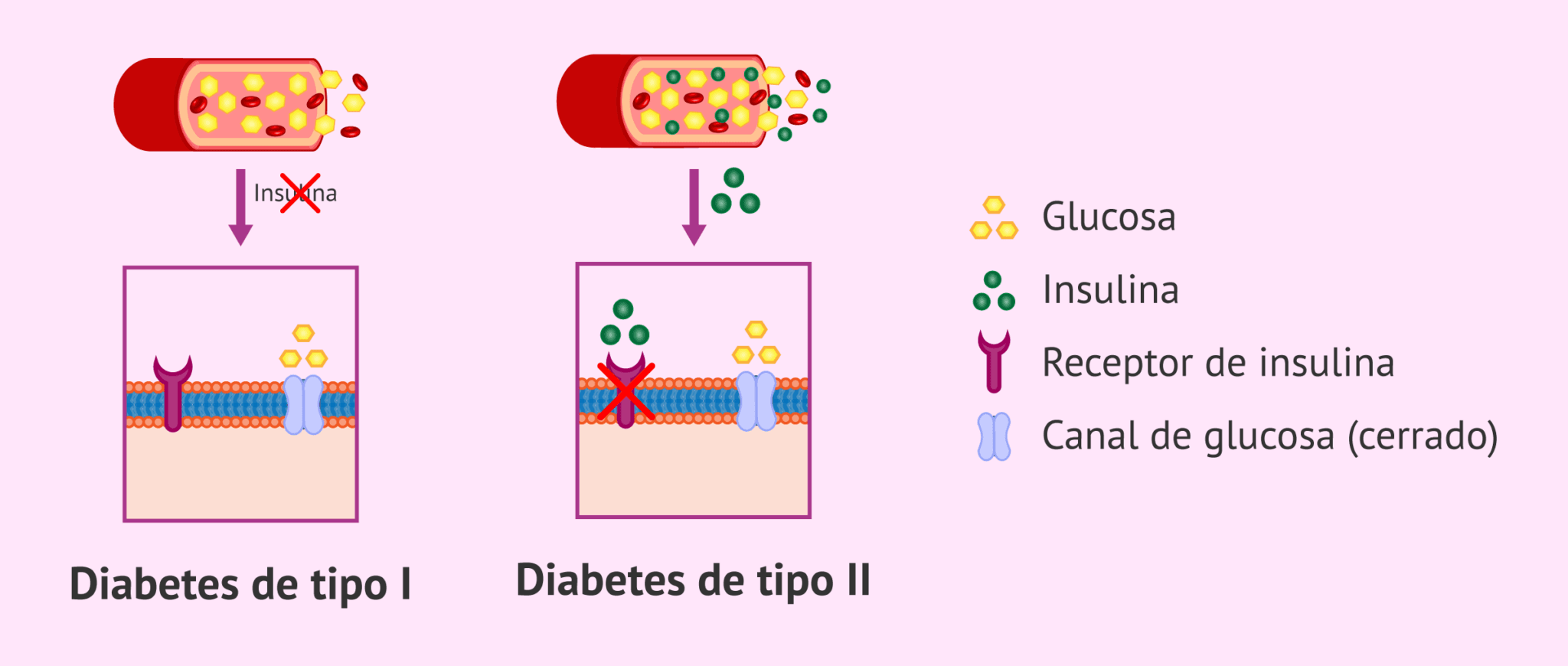 ¿Qué tipos de diabetes existen?