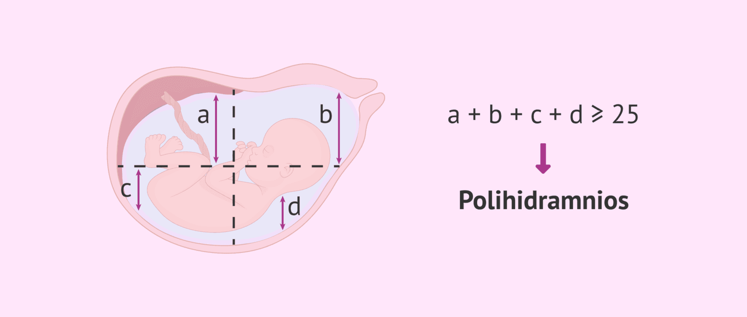 Diagnóstico del polihidramnios
