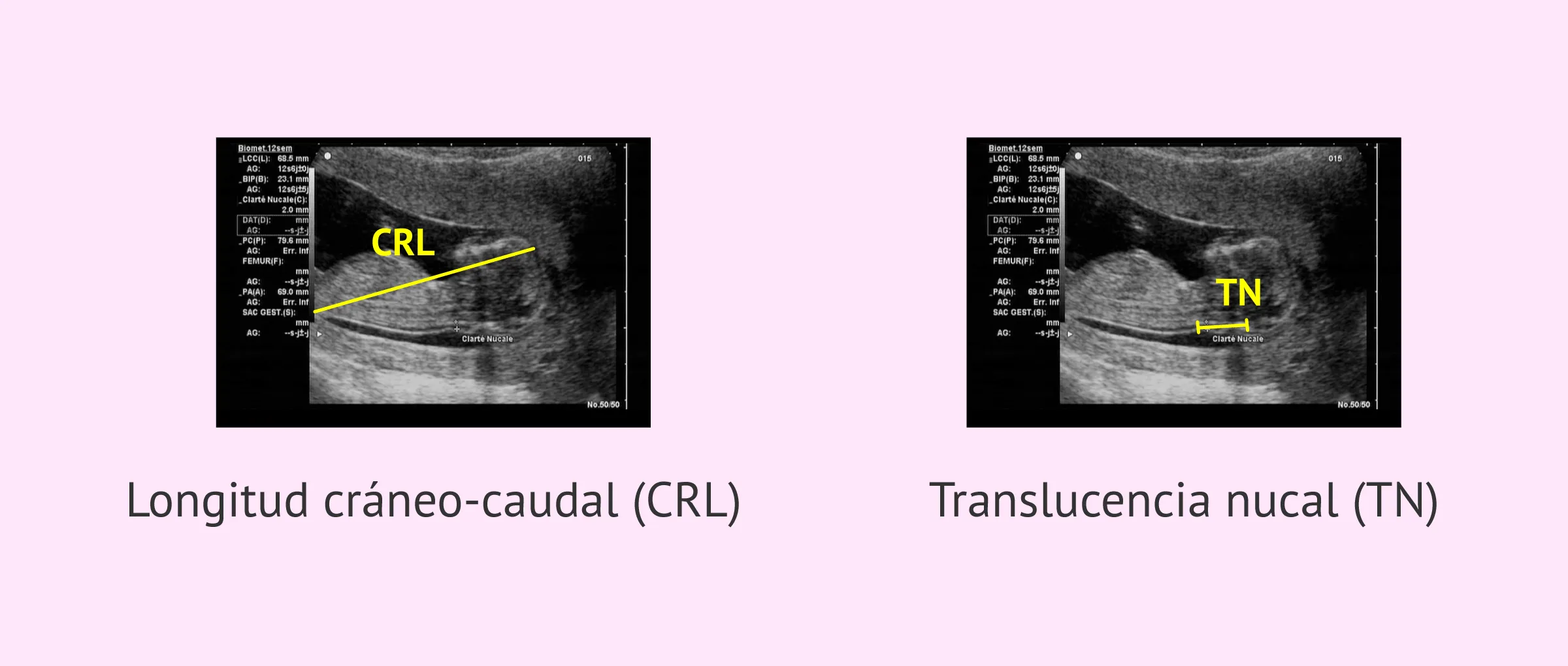 Ecografia Del Embarazo Semana A Semana La Importancia De La Ecografía