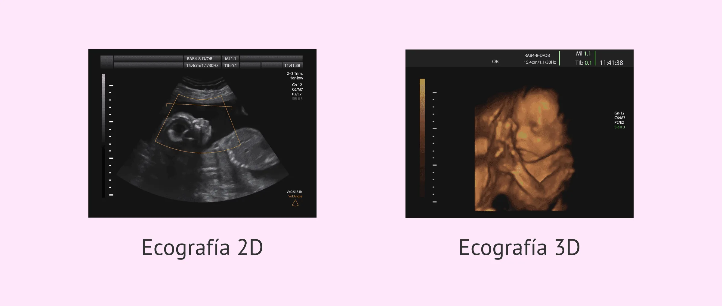 Ecografía De La Anatomía De La Cabeza Fetal